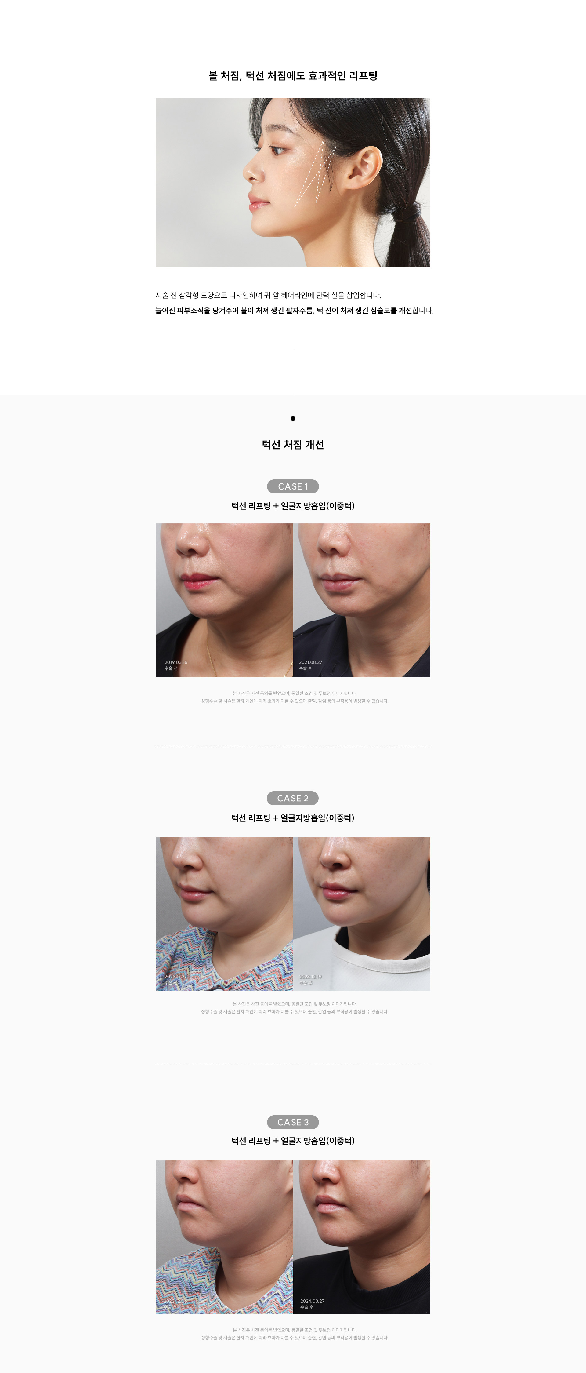 리프트 턱선 리프팅